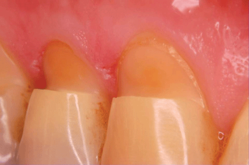 Abfraction-Myth or Reality? Why Some Wedge-shaped Cervical Lesions are ...