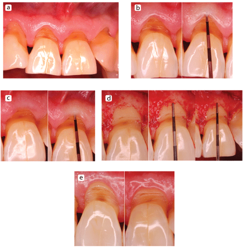 Abfraction-Myth or Reality? Why Some Wedge-shaped Cervical Lesions are ...