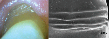 Abfraction-Myth or Reality? Why Some Wedge-shaped Cervical Lesions are ...
