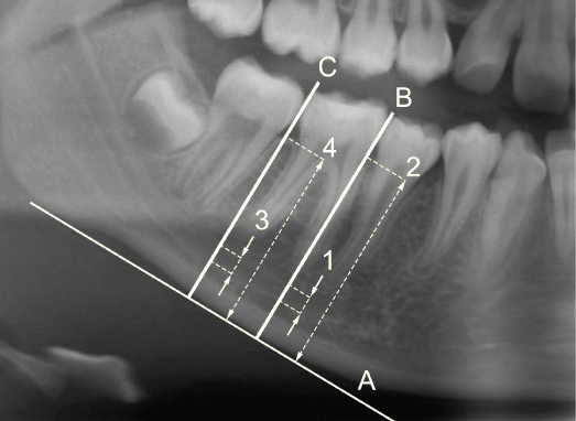 Oligodontia Related to Increased Proportion of Mandibular Canal in ...
