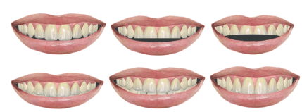 The Evaluation of Smile Design by Lay People and Dentists in the UAE