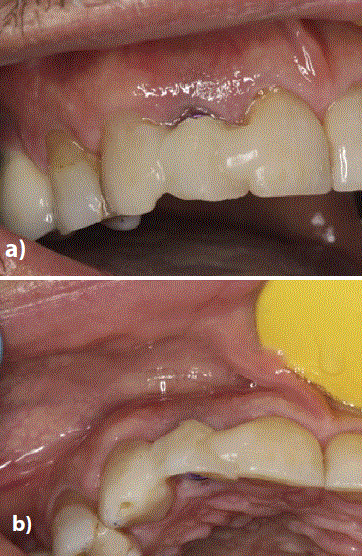 Immediate Implant Placement in Extraction Socket with an Adapted ...