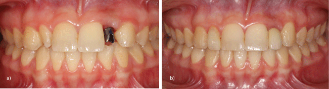 Implant Therapy for Solitary and Multiple Dental Ageneses