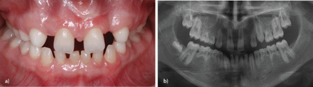 Implant Therapy for Solitary and Multiple Dental Ageneses
