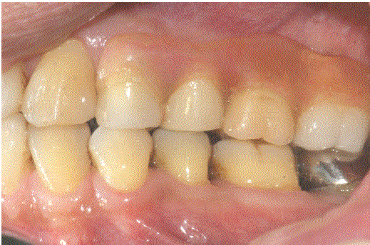Clinical Application of CSC Telescopic Denture with Magnetic Attachment ...