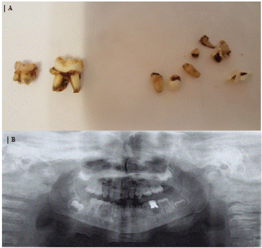 Clinical, Radiographic and Histologic Evaluation of Regional ...