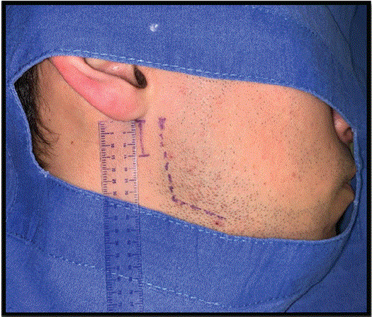 Retromandibular Approach as a Method for Open Reduction and Internal ...