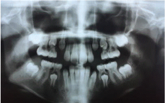 Germectomy (Therapeutic Enucleation) of First Bicuspids and Eruption ...