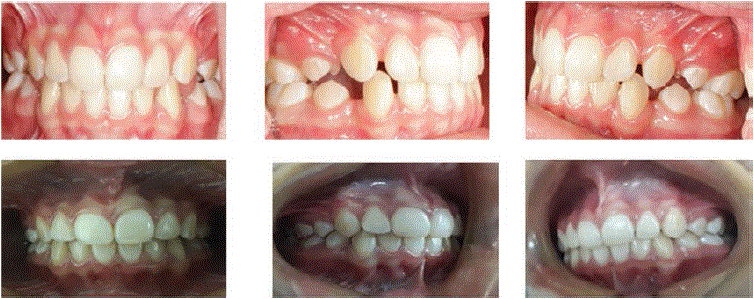 Germectomy (Therapeutic Enucleation) of First Bicuspids and Eruption ...