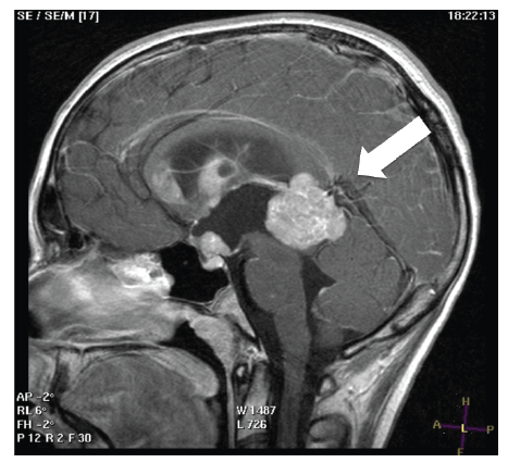 Cerebral Germinoma as a cause of Abnormal Pubertal Development in a 16 ...