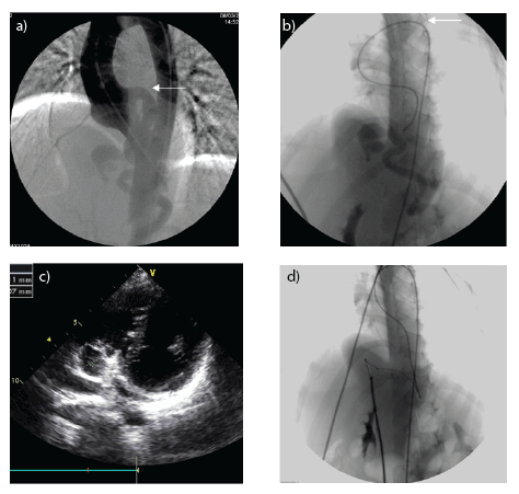 Use of DSA in Diagnosing and Treating Children Complex Coronary Artery ...