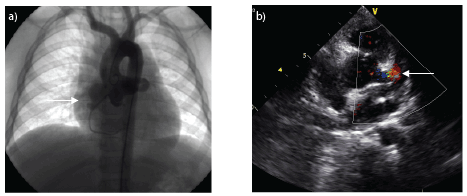 Use of DSA in Diagnosing and Treating Children Complex Coronary Artery ...