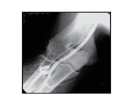 Troubleshooting in Transradial Catheterization: The Lessons Learnt so Far