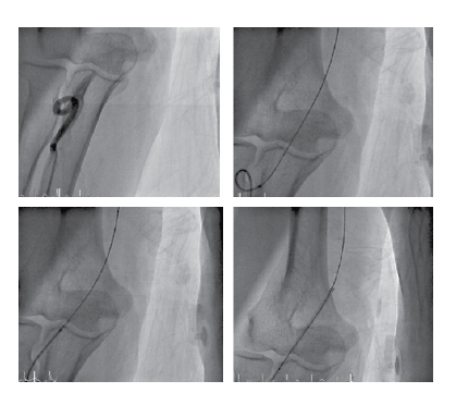 Troubleshooting in Transradial Catheterization: The Lessons Learnt so Far