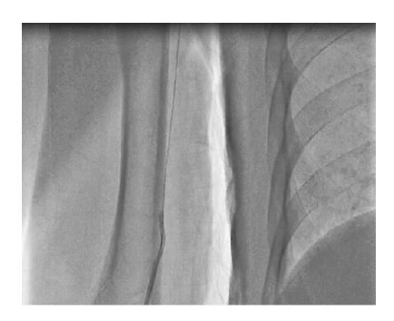 Troubleshooting in Transradial Catheterization: The Lessons Learnt so Far