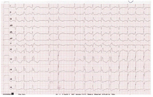 Tacrolimus as a Possible Trigger of Tachycardias in a Heart ...