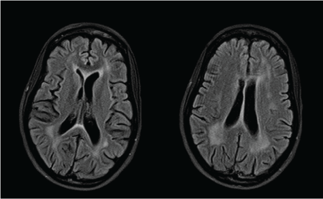 High Dose Haloperidol for Delirium in HIVAssociated Dementia