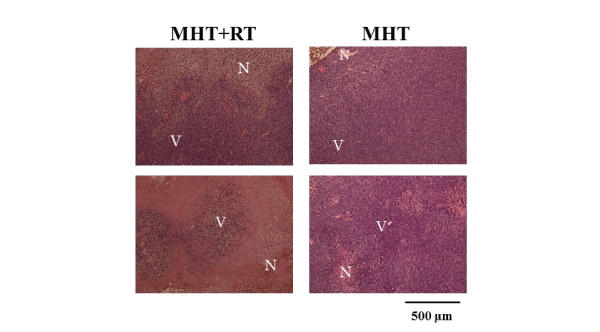 Quantitative Evaluation of Tumor Response to combination of Magnetic ...