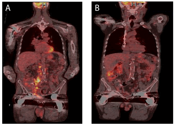 Allograft Nephrectomy for Malignancy: Report of Seven Cases and Review ...