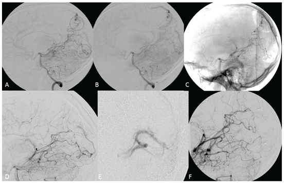 Multiple Cerebral Arteriovenous Malformation: Report of Two Cases and ...