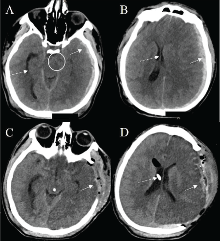 Linear Decrease in Brain Tissue Oxygenation (PbtO2) with Decreasing ...