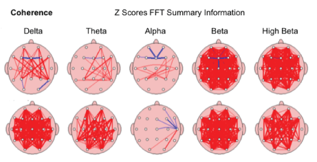 Effect of the MNRI Reflex Neuromodulation on the QEEG and ...