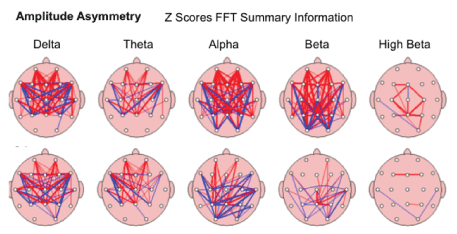 Effect of the MNRI Reflex Neuromodulation on the QEEG and ...