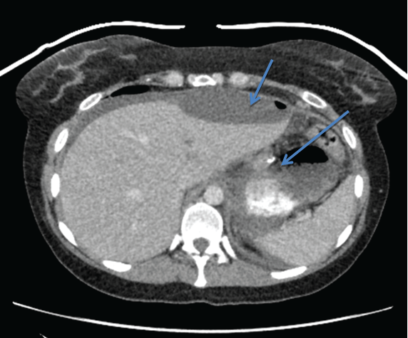 Acute Conversion of Early Sleeve Gastrectomy Leak to Roux-en-Y Gastric ...