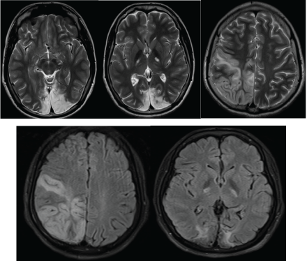 MELAS MR and Protonic-MR-Spectroscopy Findings: A Case Report