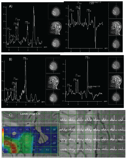 MELAS MR and Protonic-MR-Spectroscopy Findings: A Case Report
