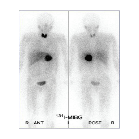 Autologous Stem Cell Treatments for High Risk Neuroblastoma