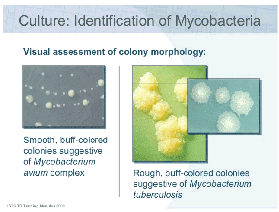 Case Presentation - Atypical Mycobacterial Cervical Lymphadenitis