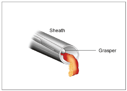 Single-Port Laparoscopy-Assisted Appendectomy in Children: A Method ...