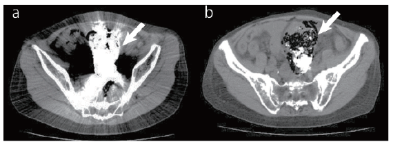 Two Cases with Perforation of the Large Intestine after Upper ...