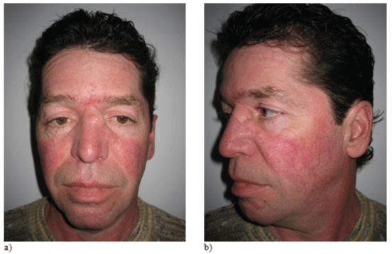 Combination of Glabellar and V-Y Cheek Advancement Flaps for Large Skin ...