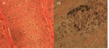 Giant Cumulated Condyloma (Tumor of Buschke-Lõwenstein)- A Case Report