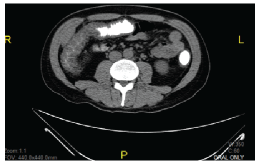 AIDS Presenting as Shigella colitis and Pneumocystis jiroveci Pneumonia ...